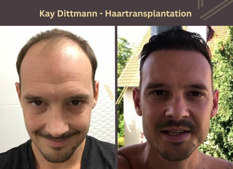 Promis mit Haartransplantation | 35 Vorher Nachher Fotos