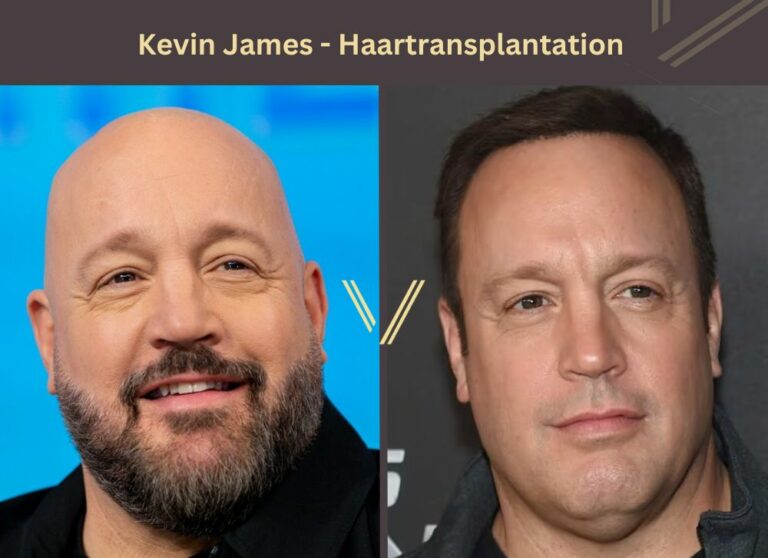 Promis mit Haartransplantation | 35 Vorher Nachher Fotos