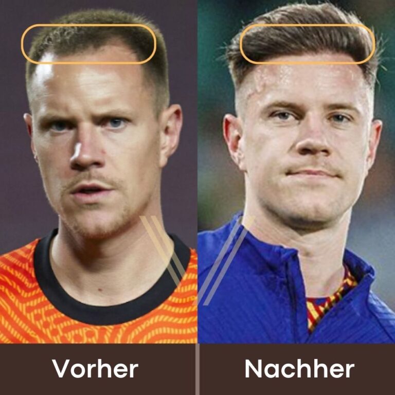 Ter Stegen Vorher Nachher