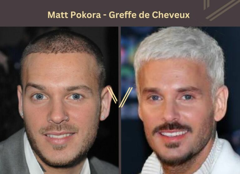 Greffe de Cheveux Chez les Stars | 35 Photos Avant et Après