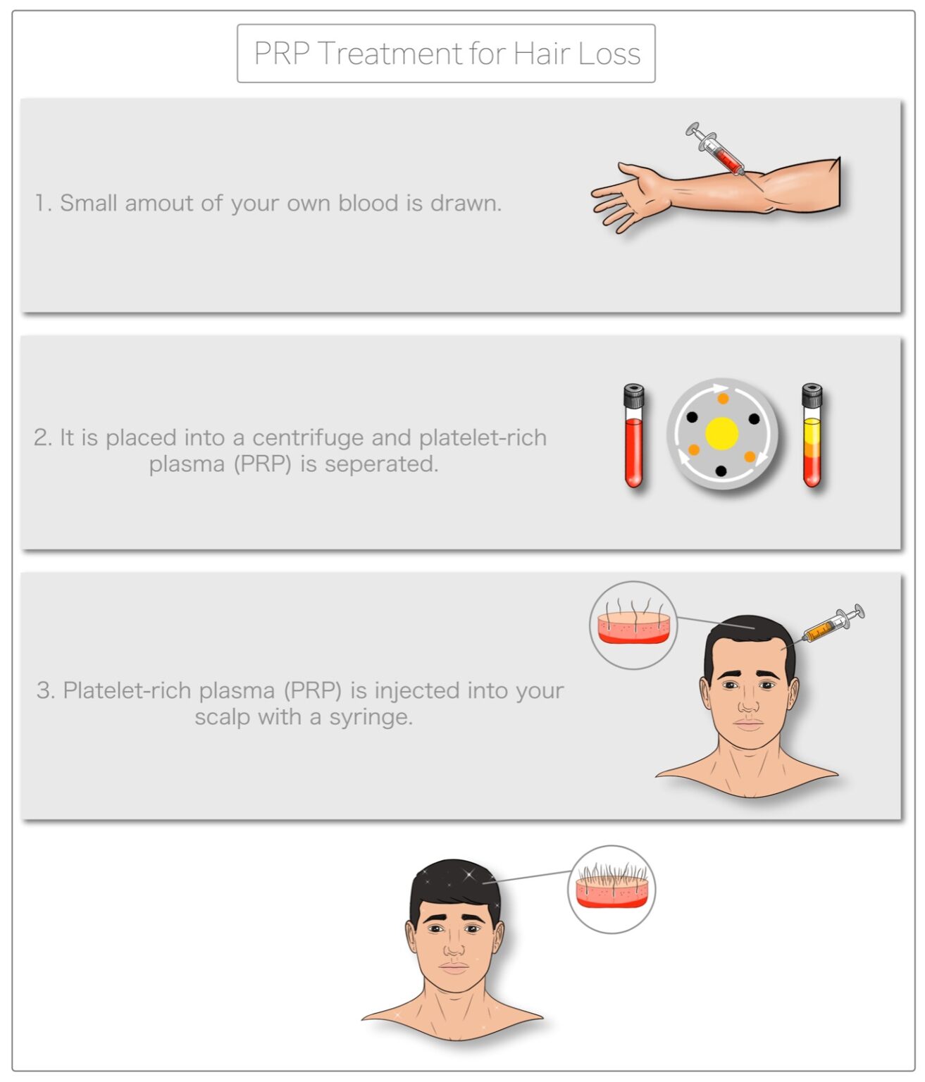 PRP Hair Treatment in Turkey | 2025 Costs | Vantage Clinic