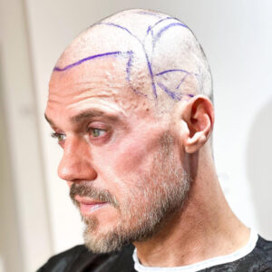 Hair Transplant Trypophobia -Causes and Symptoms