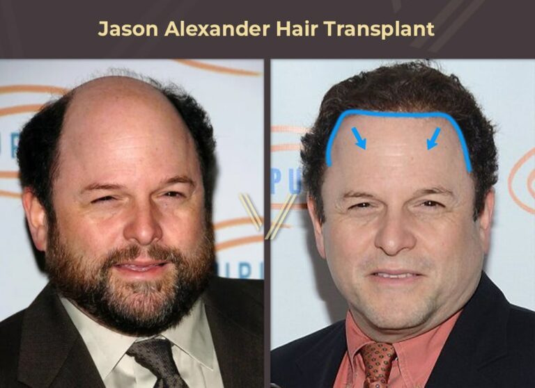 Celebrities With Hair Transplants | 104 Before & After Photos