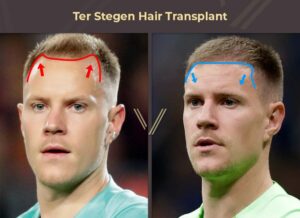 Celebrities With Hair Transplants | 104 Before & After Photos