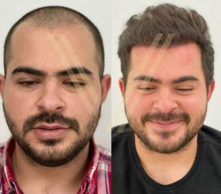 Hair Transplant Methods In Turkey Vantage Hair Transplant Clinic Turkey