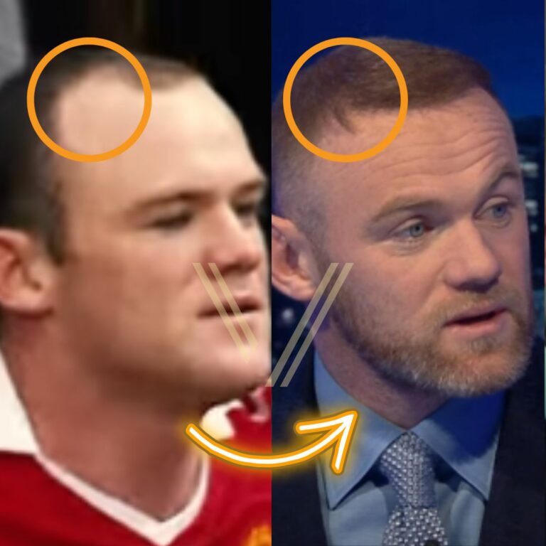 Wayne Rooney's Hair Transplant: Before and After Transformation