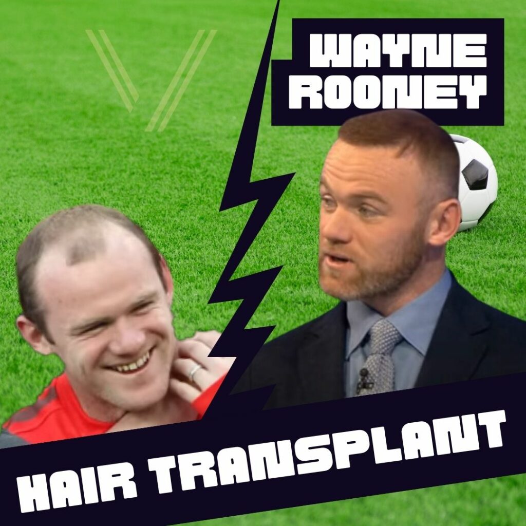 Celebrities With Hair Transplants | 40 Before & After Photos