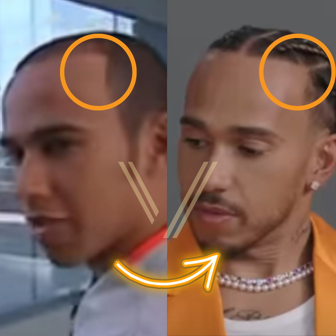 Lewis Hamilton's Hair Transplant: Before and After Transformation