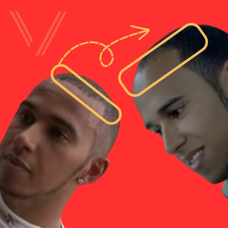 Lewis Hamilton's Hair Transplant: Before and After Transformation