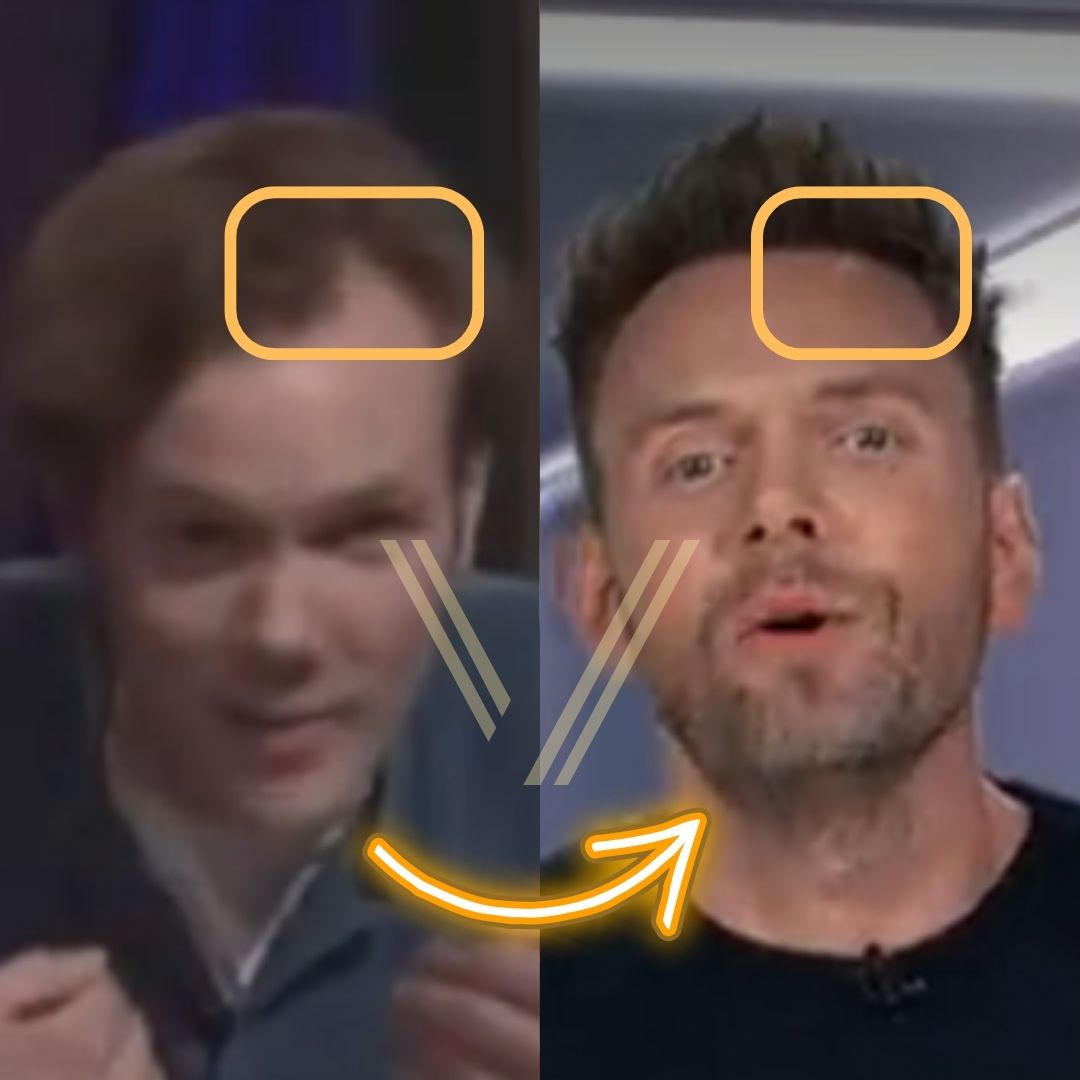 Joel McHale Hair Transplant: Before and After Transformation