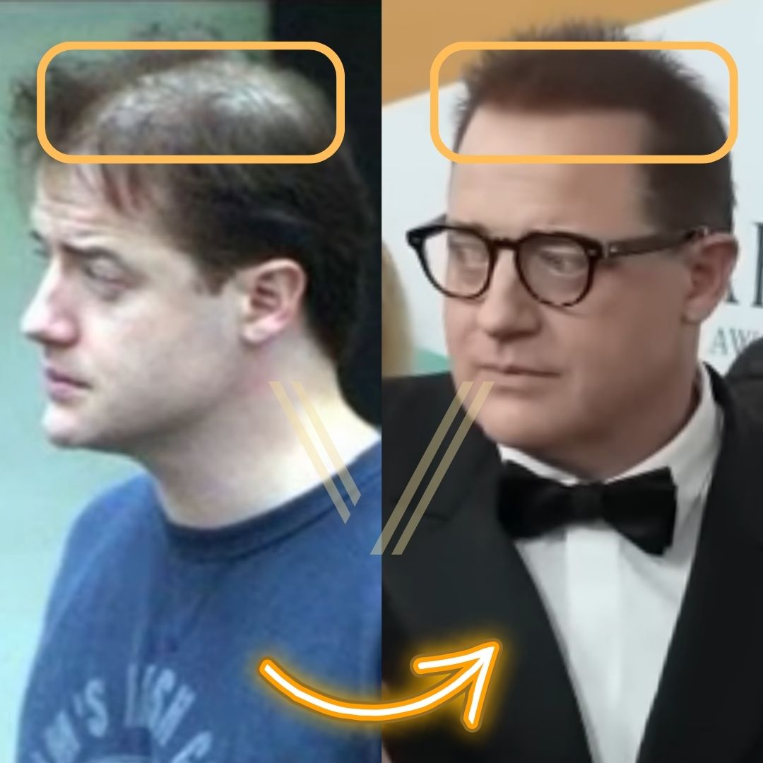 Brendan Fraser Hair Transplant: Before and After Transformation