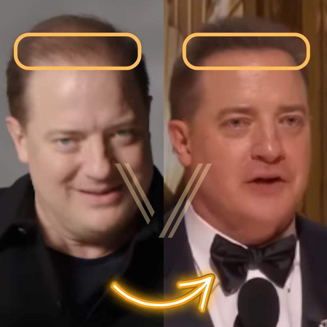 Brendan Fraser Hair Transplant: Before and After Transformation