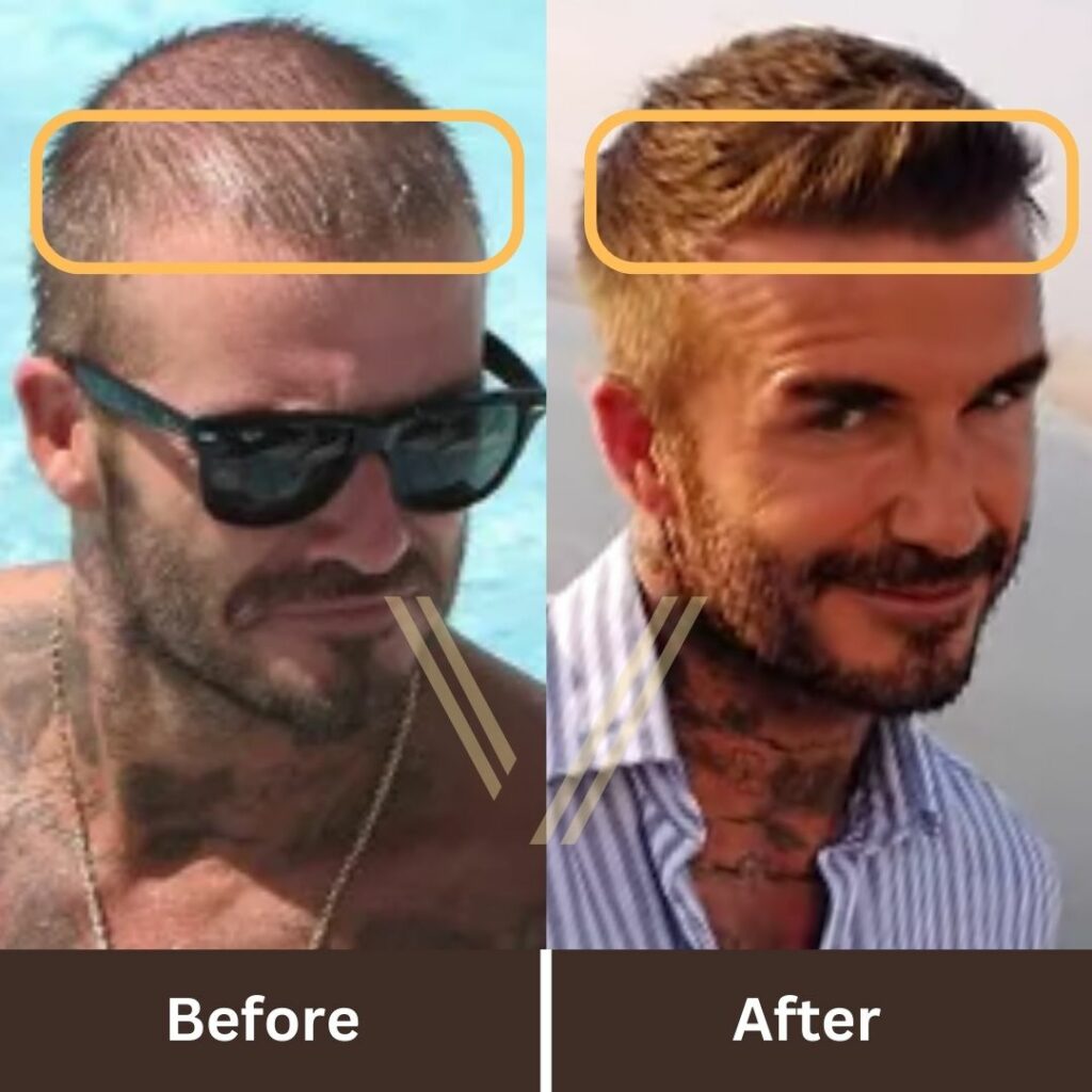 David Beckham’s Hair Transplant: Before and After Transformation