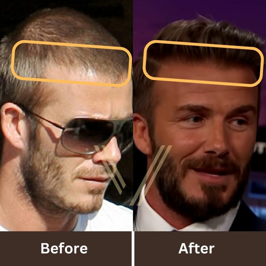 David Beckham’s Hair Transplant: Before and After Transformation