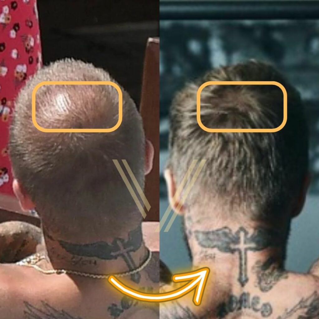 David Beckham’s Hair Transplant: Before and After Transformation