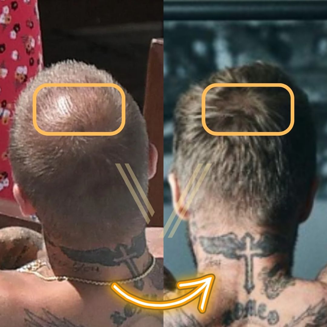 David Beckham’s Hair Transplant: Before and After Transformation