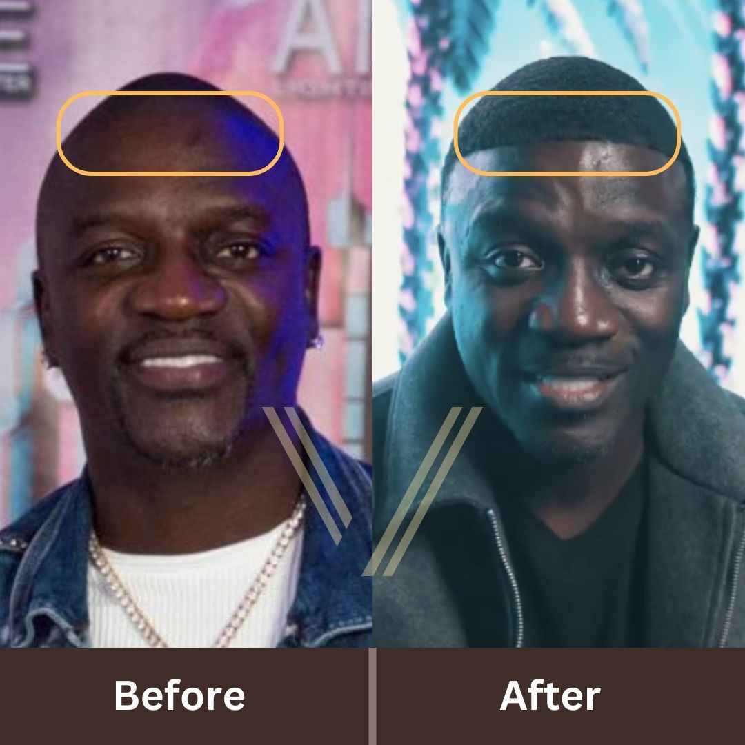 Akon Hair Transplant: Before and After Transformation