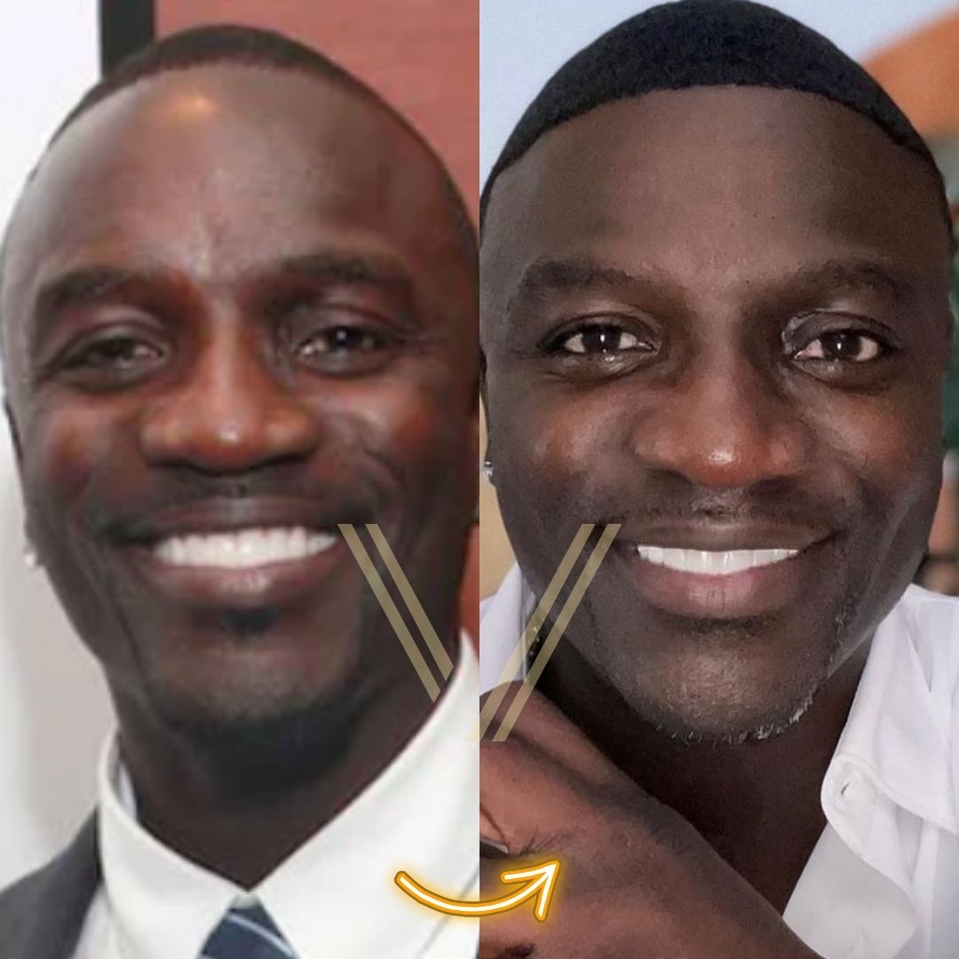 Akon Hair Transplant: Before and After Transformation