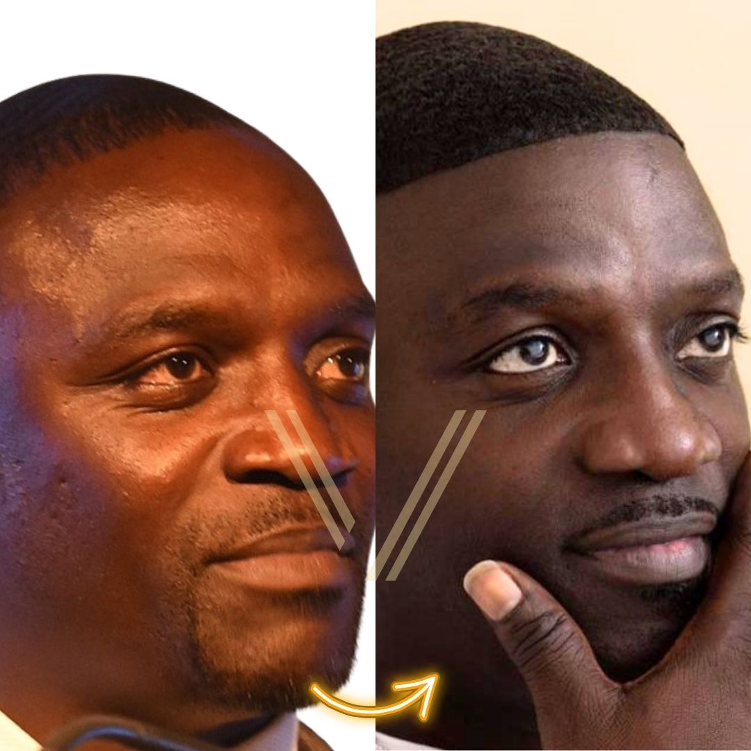 Akon Hair Transplant: Before and After Transformation