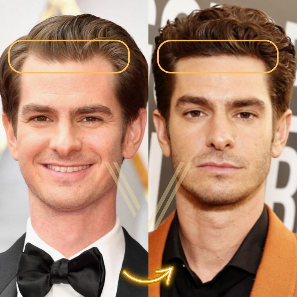 Andrew Garfield Hair Transplant: Before and After Transformation