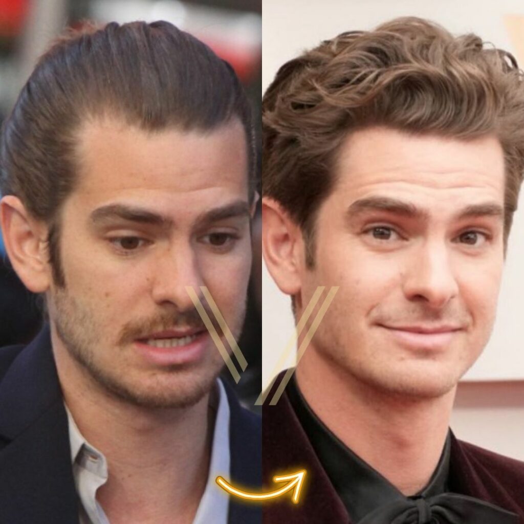 Andrew Garfield Hair Transplant: Before and After Transformation