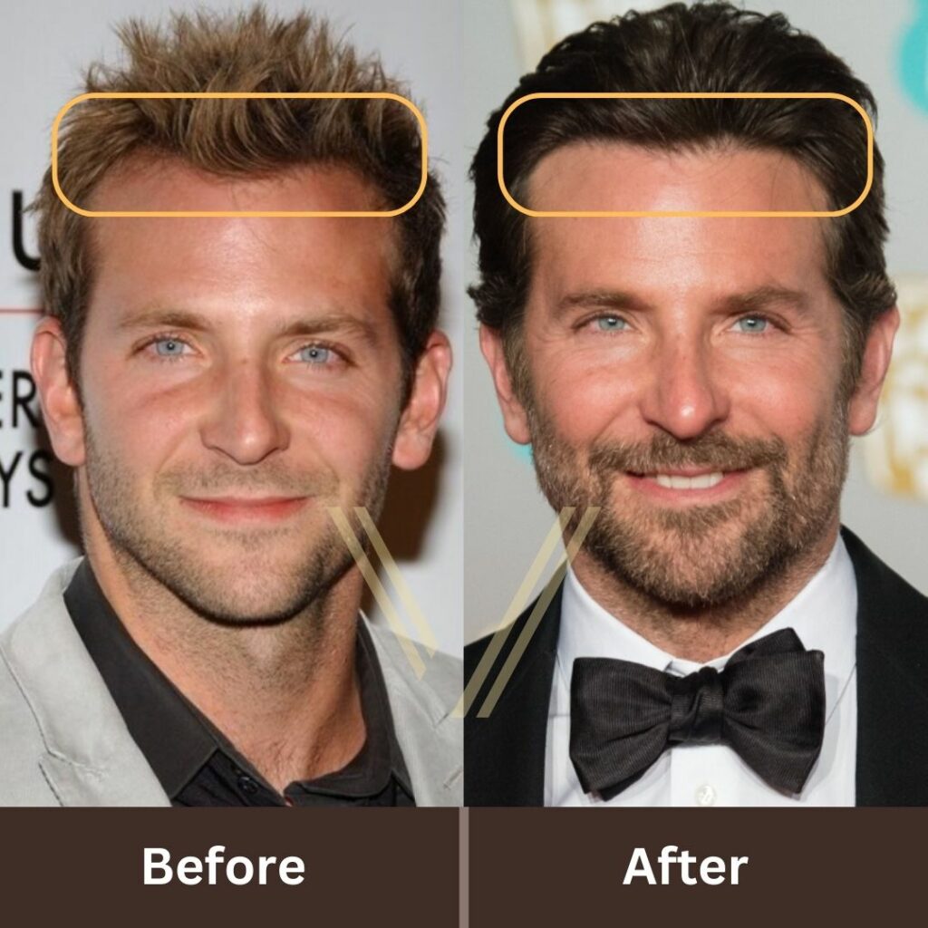 Bradley Cooper's Hair Transplant: Before and After Transformation
