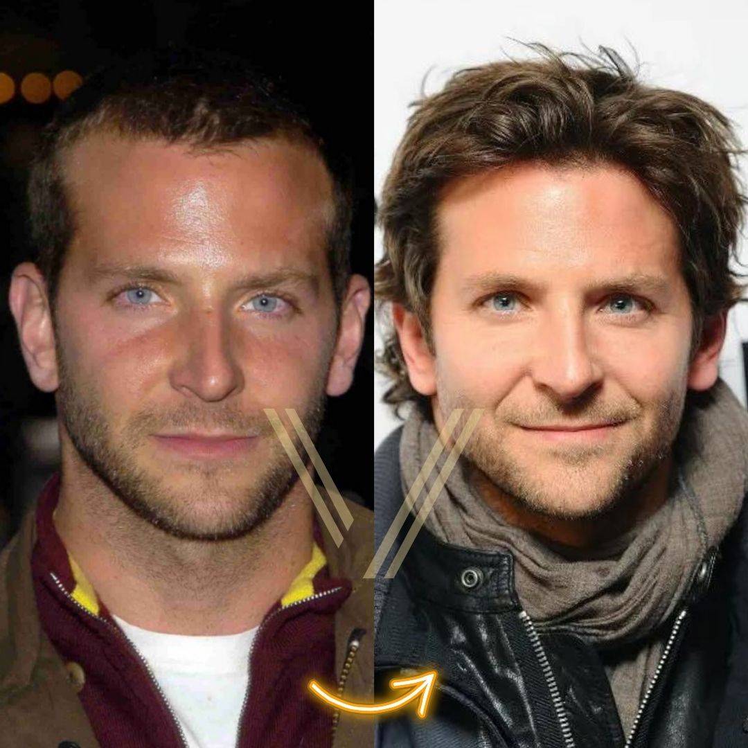 Bradley Cooper's Hair Transplant: Before and After Transformation