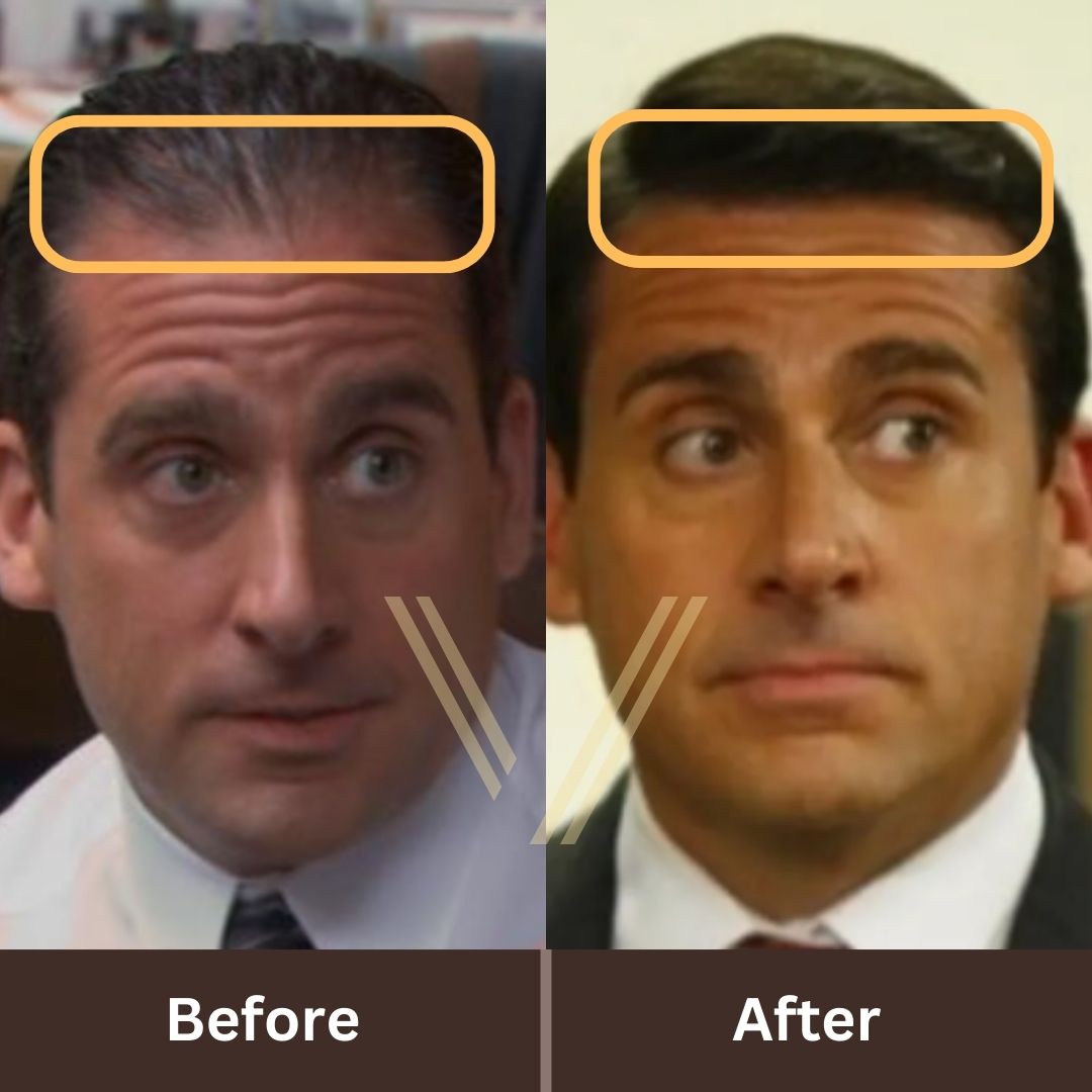 Steve Carell's Hair Transplant: Before and After Transformation