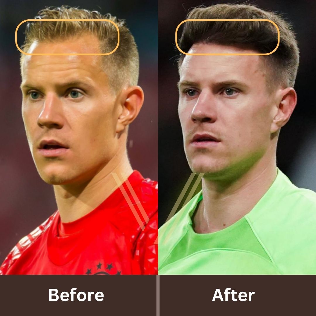 Ter Stegen's Hair Transplant: Before and After Transformation