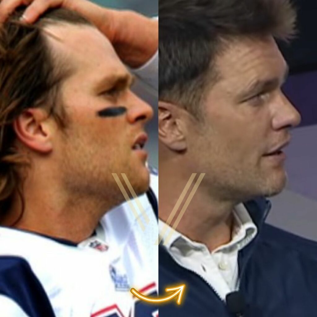 Tom Brady Hair Transplant: Before and After Transformation