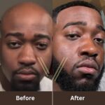 JiDion Hair Transplant: Before and After Transformation