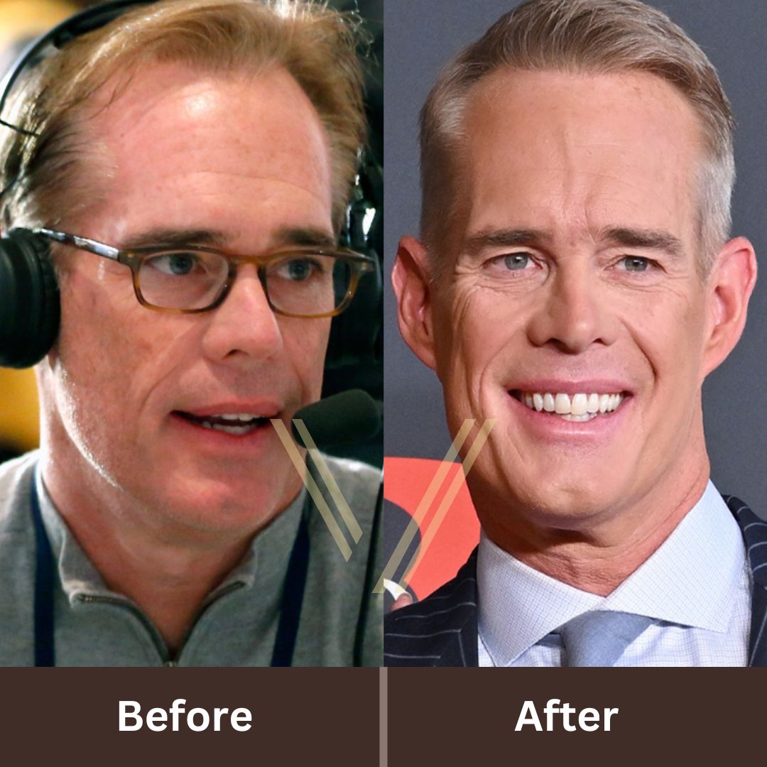 Joe Buck Hair Transplant - Before and After