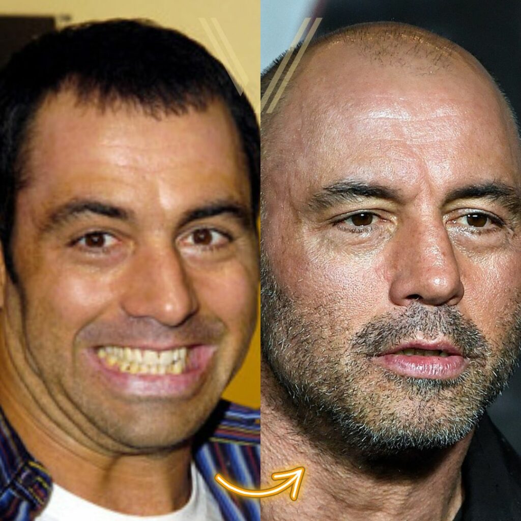 Joe Rogan Hair Transplant: Before and After Transformation