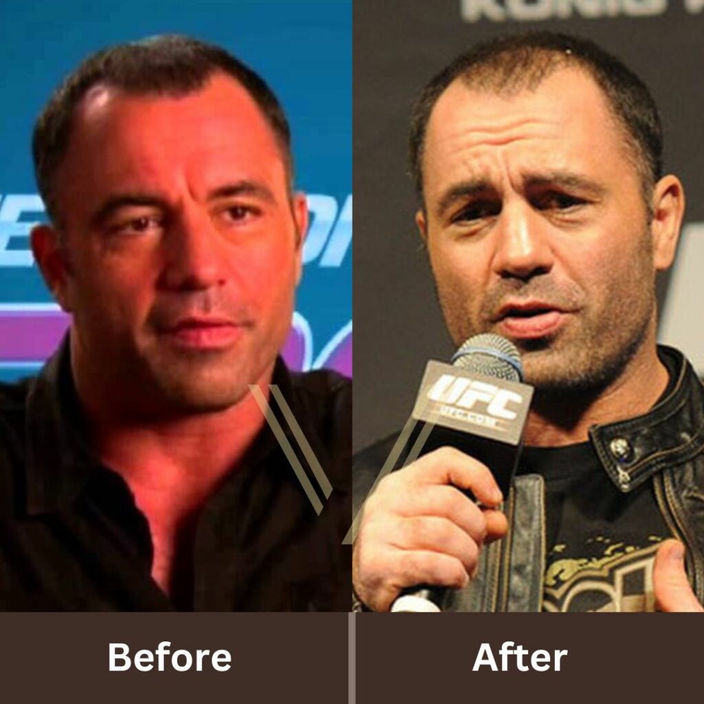 Joe Rogan's Hair Transplant: Before and After Transformation