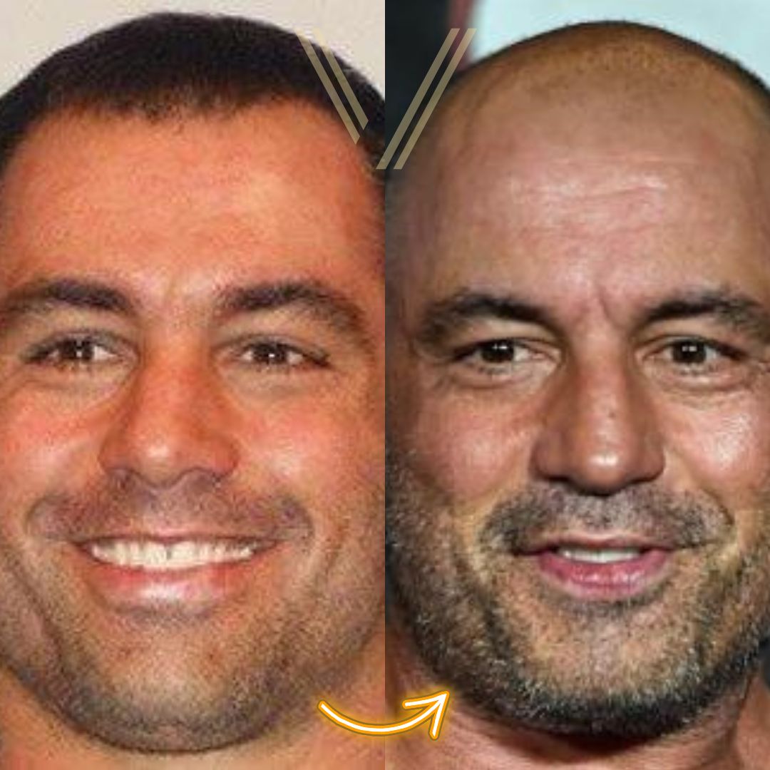 Joe Rogan Hair Transplant: Before and After Transformation