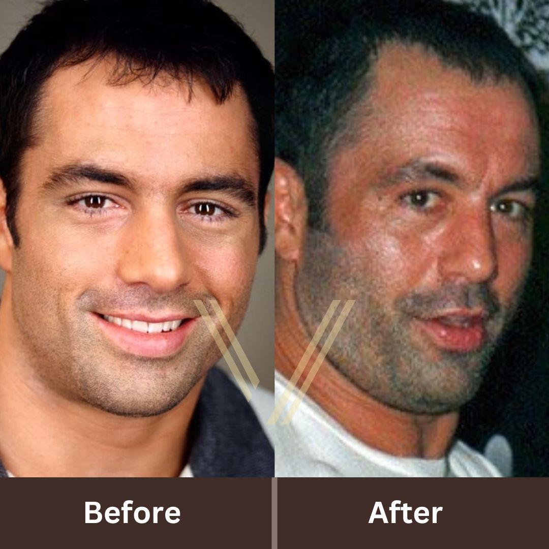 Joe Rogan Hair Transplant: Before and After Transformation