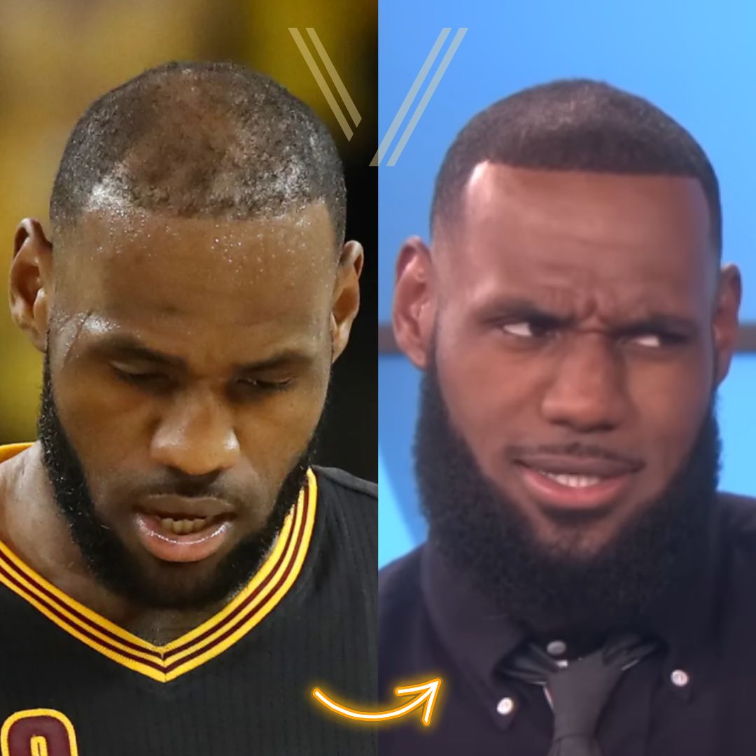 LeBron James Hair Transplant: Before and After Transformation