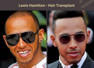 Black Celebrity Hair Transplant - 27 Before and After Photos