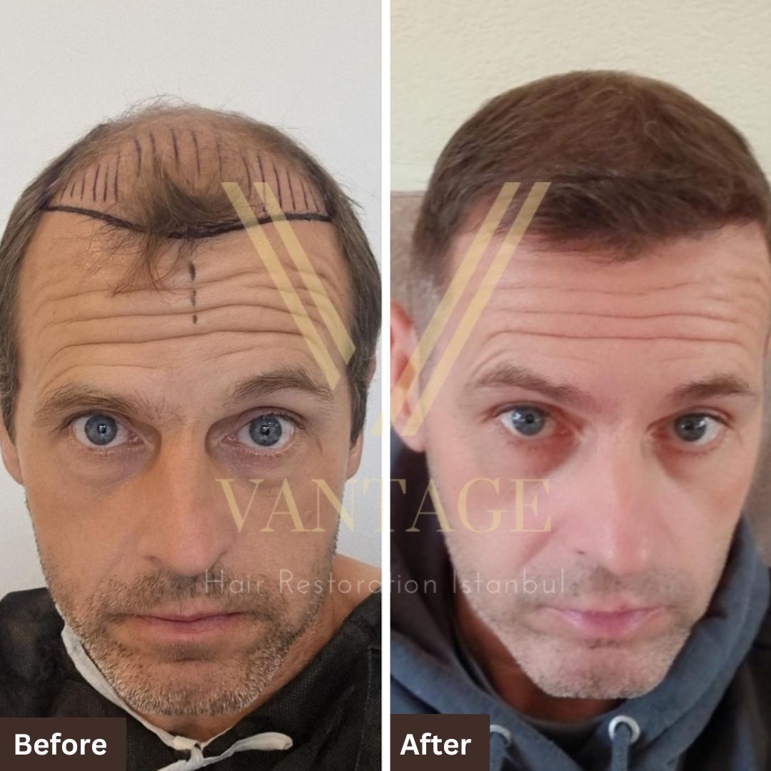 8000 Grafts Hair Transplant in Turkey - Cost - Before and After