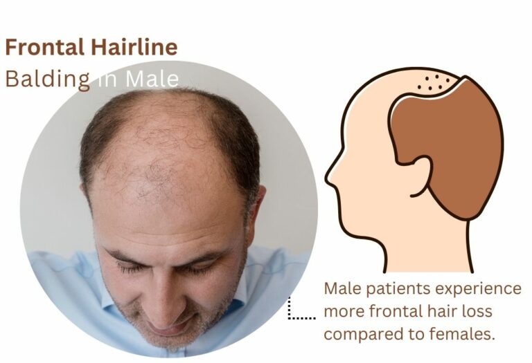 Frontal Hairline Balding Causes and Treatments | Vantage Hair ...