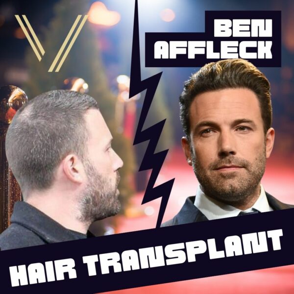 Ben Affleck’s Hair Transplant: Before and After Transformation
