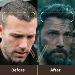 Ben Affleck’s Hair Transplant: Before and After Transformation
