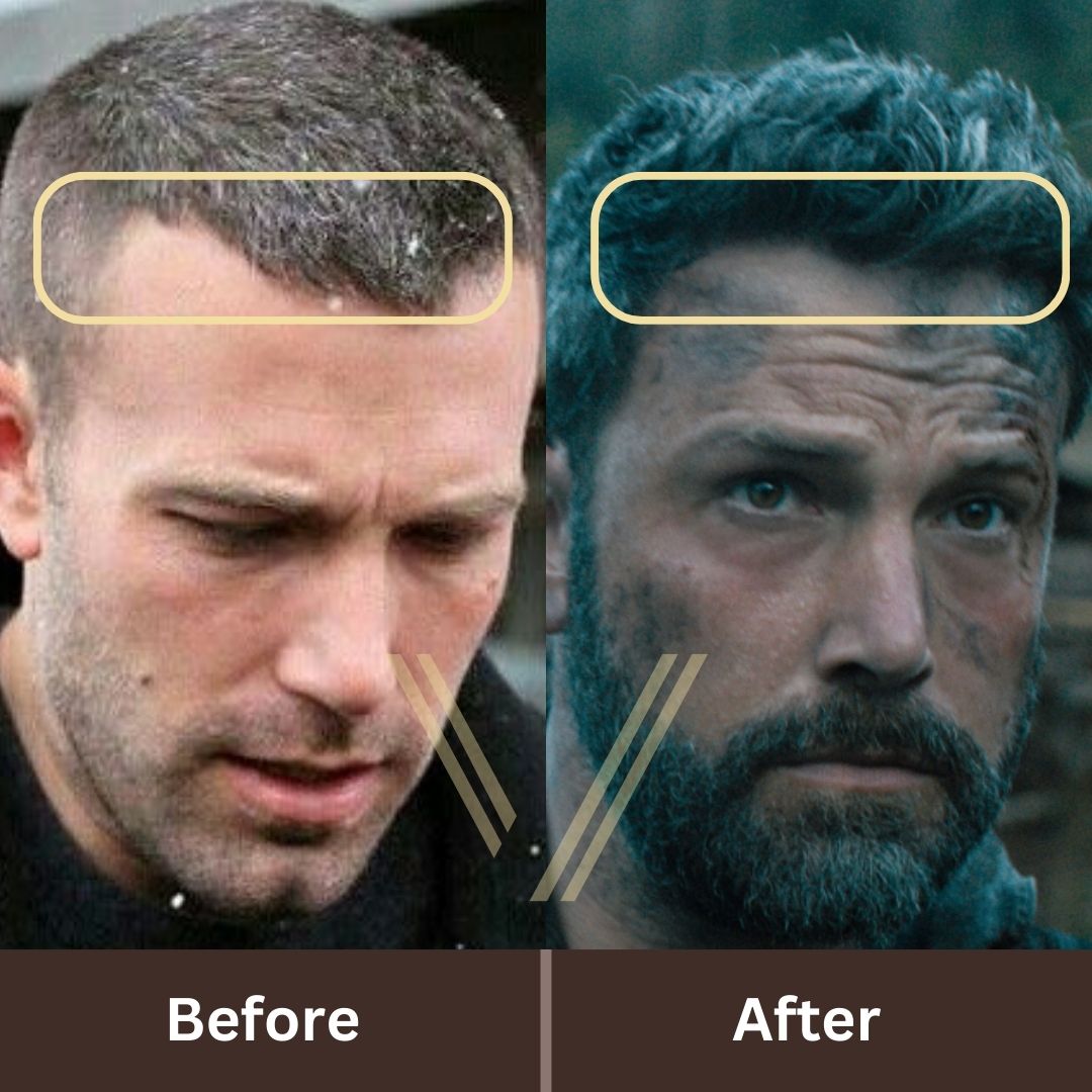 Ben Affleck’s Hair Transplant: Before and After Transformation