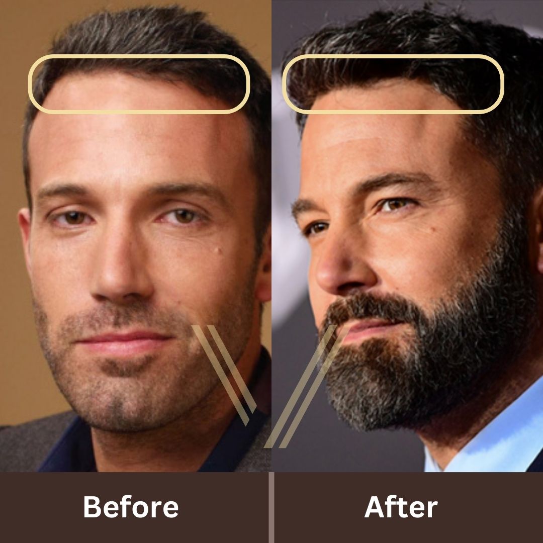 Ben Affleck’s Hair Transplant: Before and After Transformation