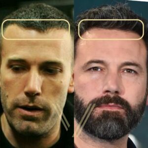 Ben Affleck’s Hair Transplant: Before and After Transformation