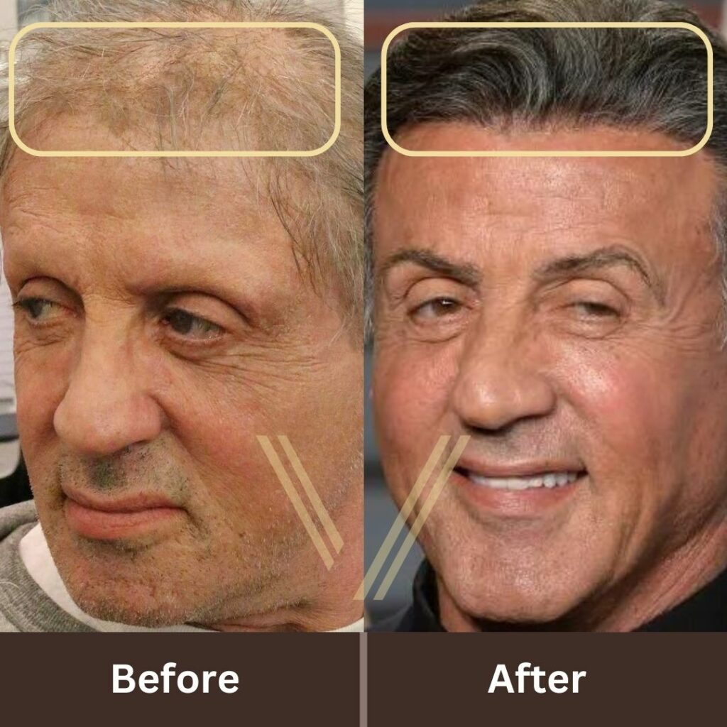 Sylvester Stallone Hair Transplant: Before and After Result