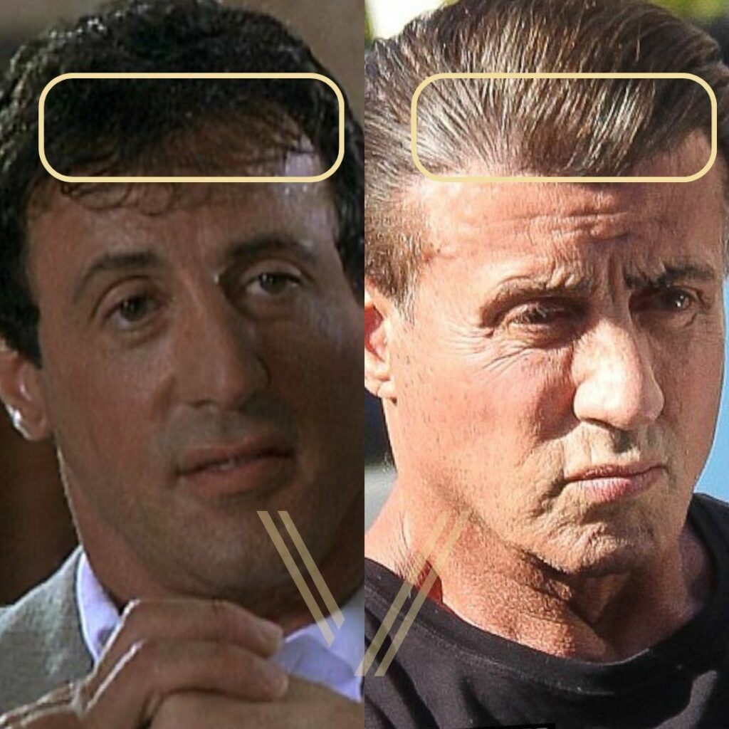 Sylvester Stallone Hair Transplant: Before and After Result