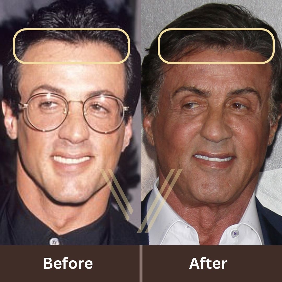 Sylvester Stallone Hair Transplant: Before and After Result
