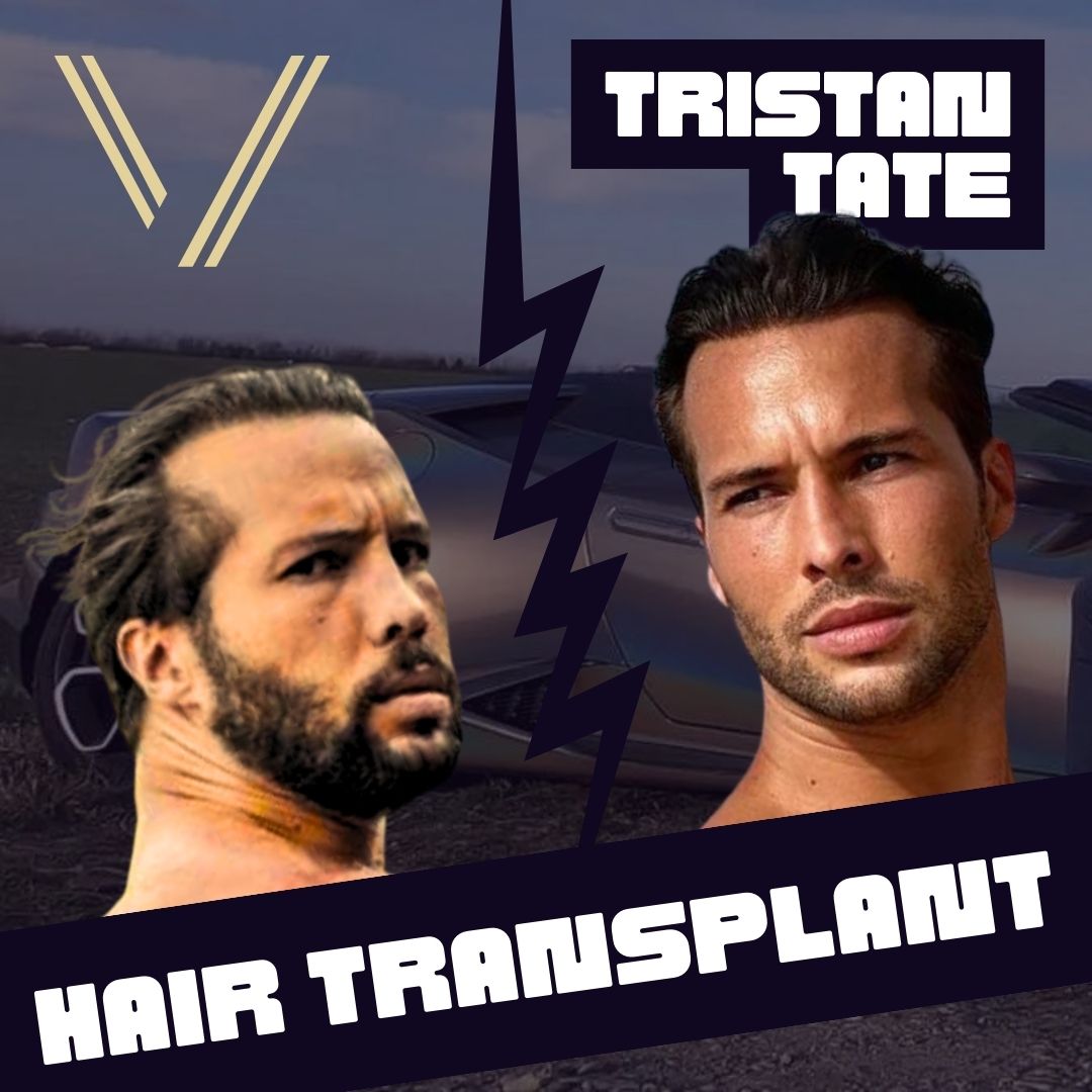 Tristan Tate's Hair Transplant: Before and After Result