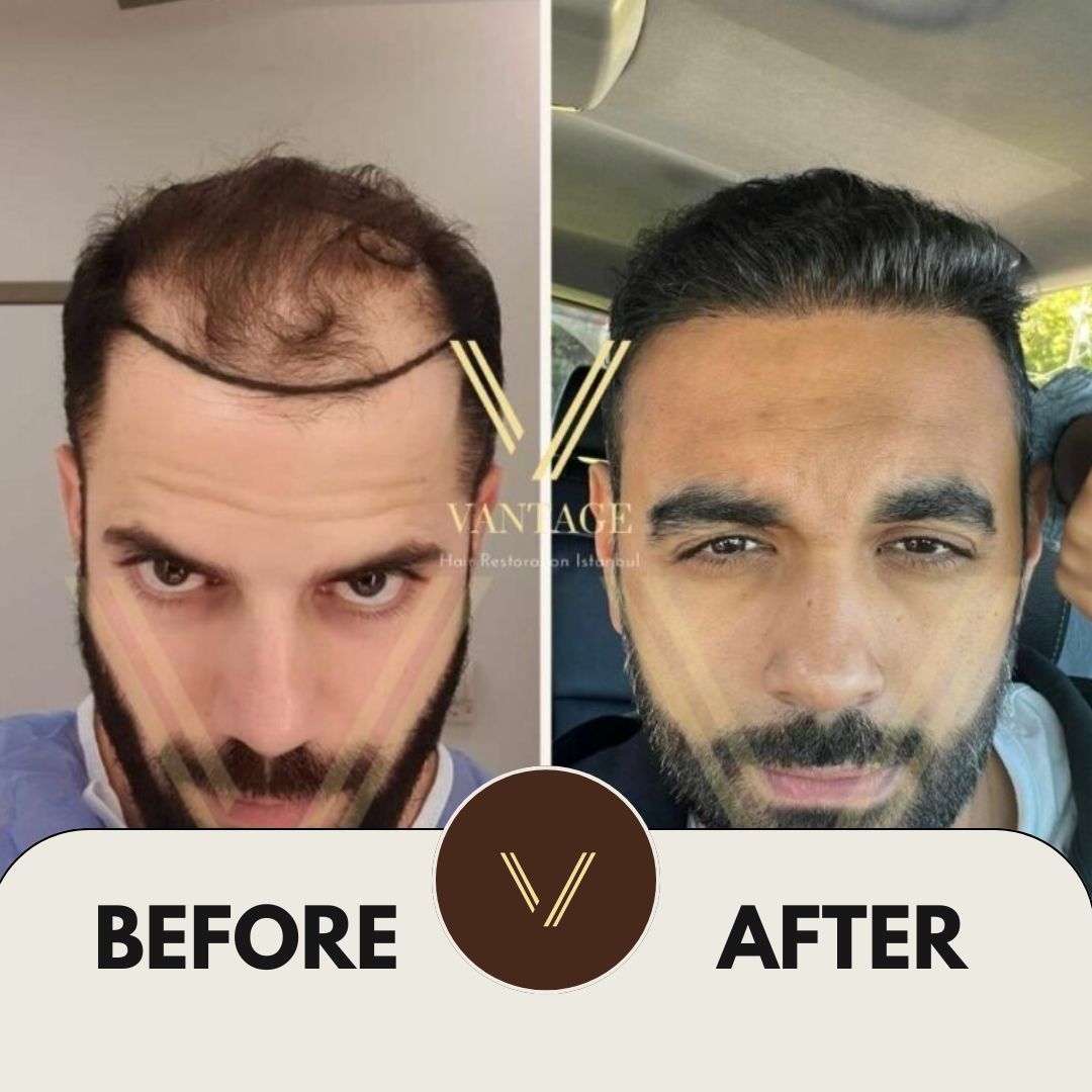 Hair Transplant for Receding Hairline - Vantage Hair Transplant Clinic ...